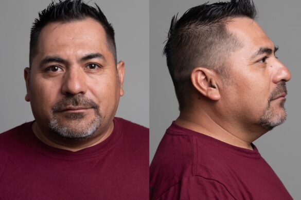 Avoid After Botox: The 10 Most Important Don’ts – Aesthetic Report